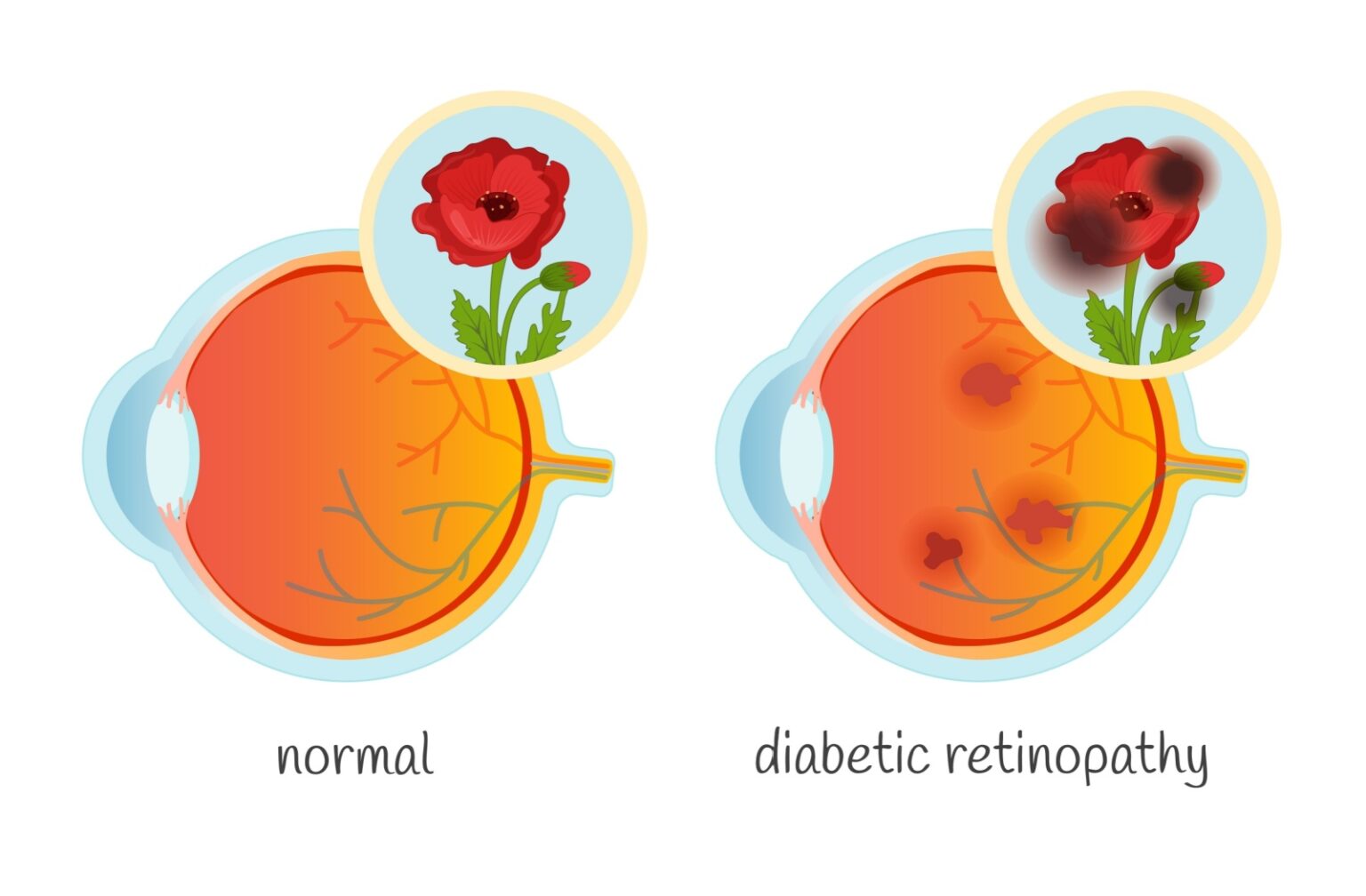 Can Diabetic Retinopathy Be Reversed?
