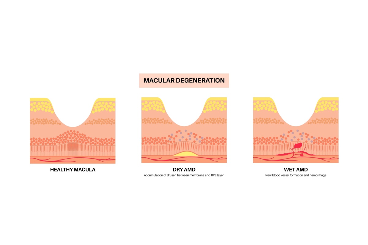 What Is Macular Degeneration?